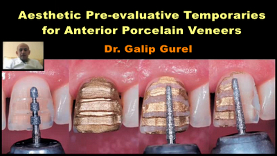 Aesthetic Pre-evaluative Temporaries for Anterior Porcelain Veneers ...