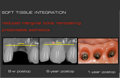 Biological Data for Bone & Soft Tissue Integration - Dental Videos