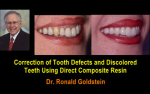 Correction of Tooth Defects and Discolored Teeth Using Direct Composite ...