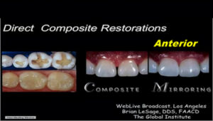 Direct Composite Restorations Course: Anterior, Posterior, Finishing ...