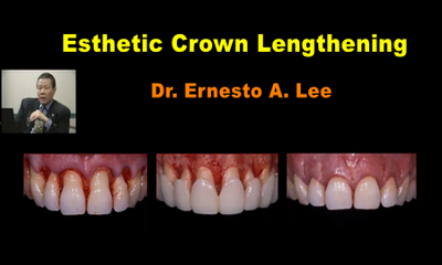 Esthetic Crown Lengthening - Dental Videos