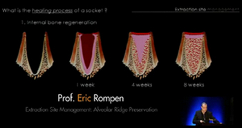 Extraction Site Management for Alveolar Ridge Preservation - Dental Videos