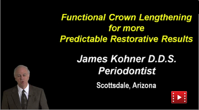 Functional Crown Lengthening For More Predictable Results - Dental Videos