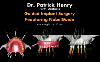 Guided Surgery for the Immediate Loading of Implant (2 Videos) - Dental ...