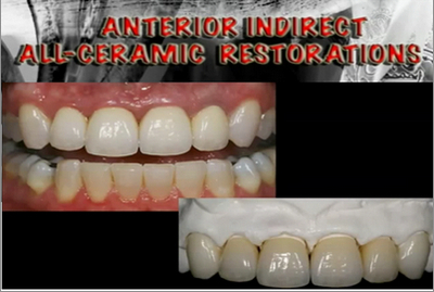 Indirect Anterior Restorations: Veneers and Crowns - Dental Videos