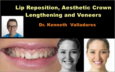 Lip Reposition, Aesthetic Crown Lengthening and Veneers - Dental Videos