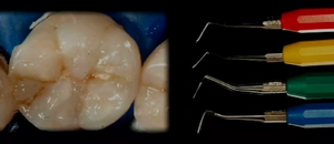 Plastic Restorations in Posterior Teeth - Free Dental Lecture