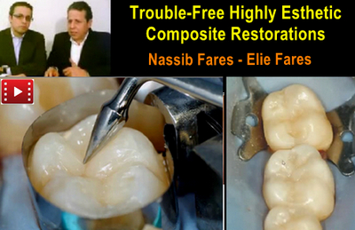 Trouble-Free Highly Esthetic Composite Restorations - Dental Videos