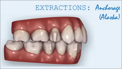 Invisalign and Extractions - Dental Videos