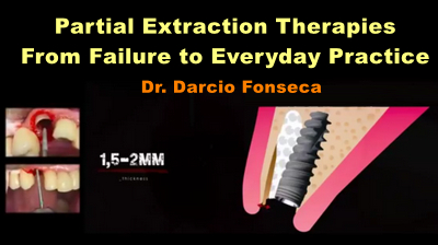 Partial Extraction Therapies From Failure to Everyday Practice - Dental ...