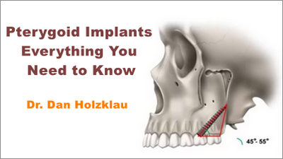Pterygoid Implants: Everything You Need to Know - Dental Videos