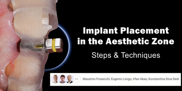 Implant Placement in the Aesthetic Zone: Steps & Techniques - Dental Videos