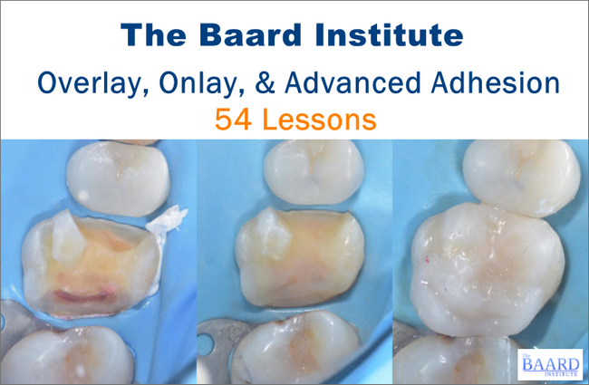 Overlay, Onlay, & Advanced Adhesion - Dental Videos