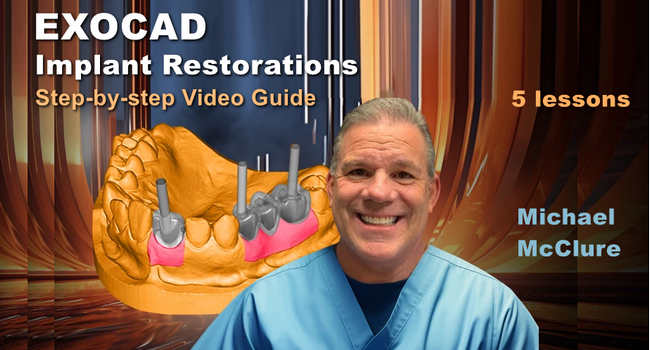 EXOCAD Implant Restorations: Step-by-step Video Guide - Dental Videos