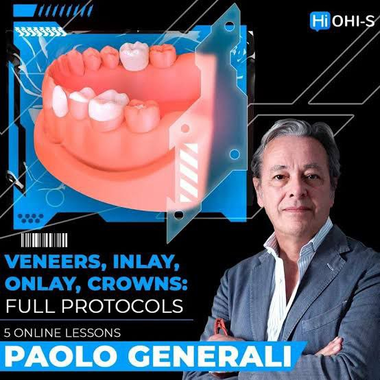 Veneers, Inlay, Onlay, Crowns: Full Protocols - Dental Videos