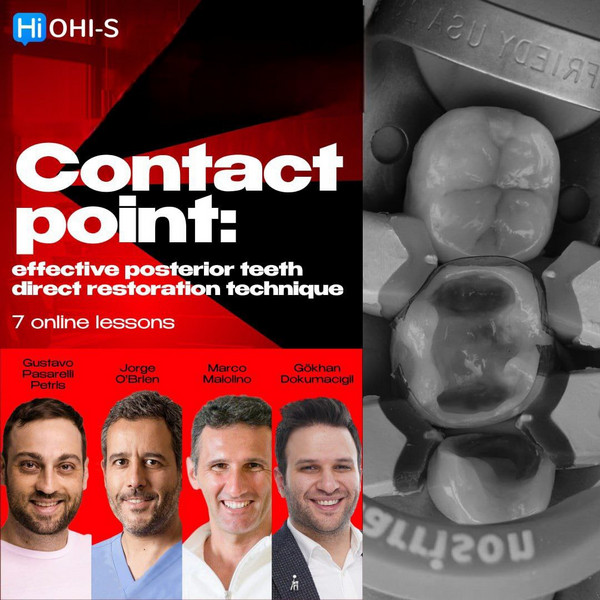 Contact Point: Effective Posterior Teeth Direct Restoration Technique ...